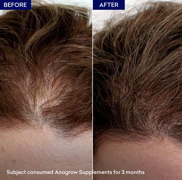 ANAGROW SOFT GEL CAPSULES |10,000mcg – abheea.pk